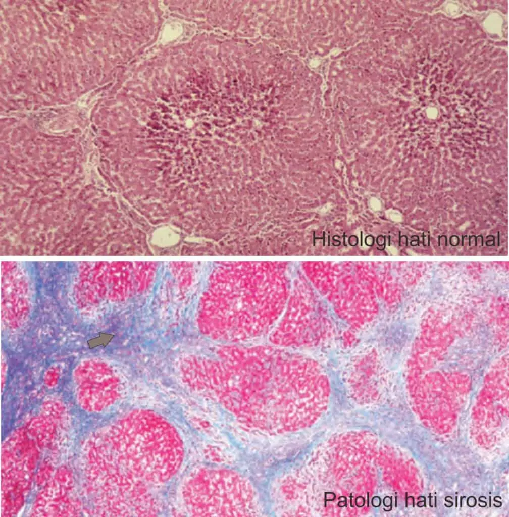 Patofisiologi dan Patogenesis Sirosis Hati – Kedokteran – Caiherang