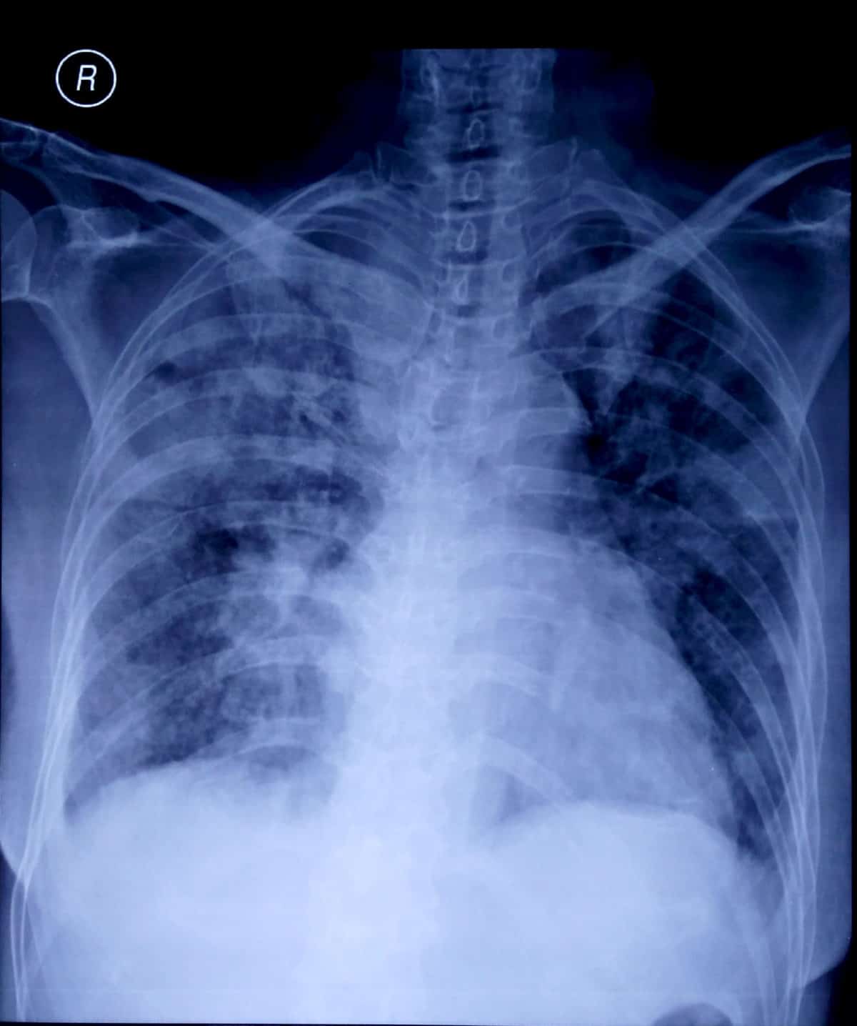 Tatalaksana Community Acquired Pneumonia (CAP) | ATS/IDSA 2019 ...