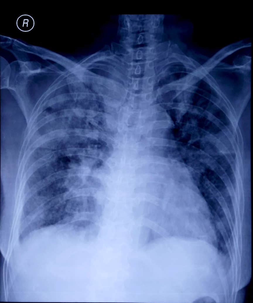 Tatalaksana Community Acquired Pneumonia (CAP) | ATS/IDSA 2019 - Caiherang