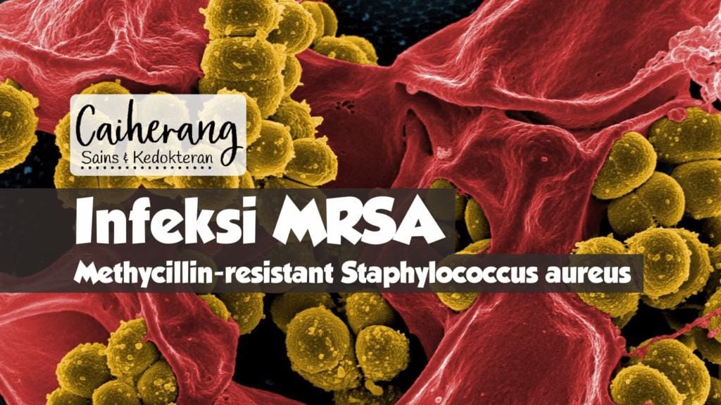 Infeksi MRSA (Methycillin-Resistant Staphylococcus aureus) – Kedokteran ...