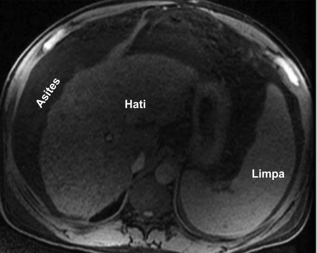 Gambaran Radiologis Sirosis Hati - Caiherang