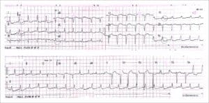 UAP (Unstable Angina Pectoris) dan NSTEMI (Non ST-Elevated Myocardial ...