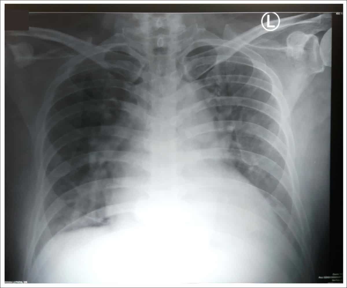 UAP (Unstable Angina Pectoris) dan NSTEMI (Non ST-Elevated Myocardial ...