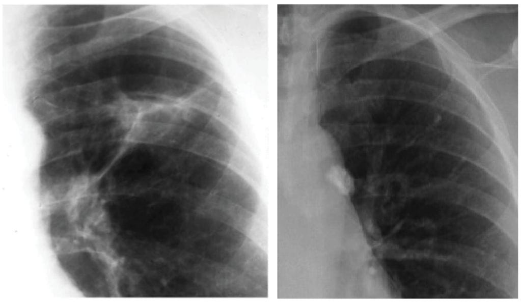 Tuberkulosis (TB): Patofisiologi, Diagnosis, & Tatalaksana – Kedokteran ...